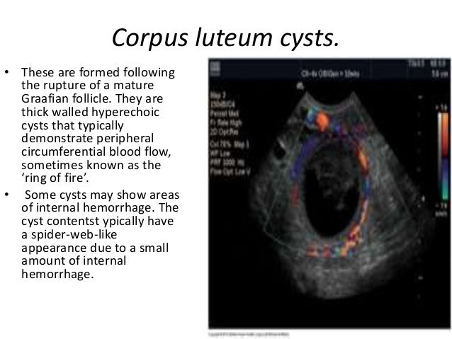 Role of ultrasound in ovarian lesions