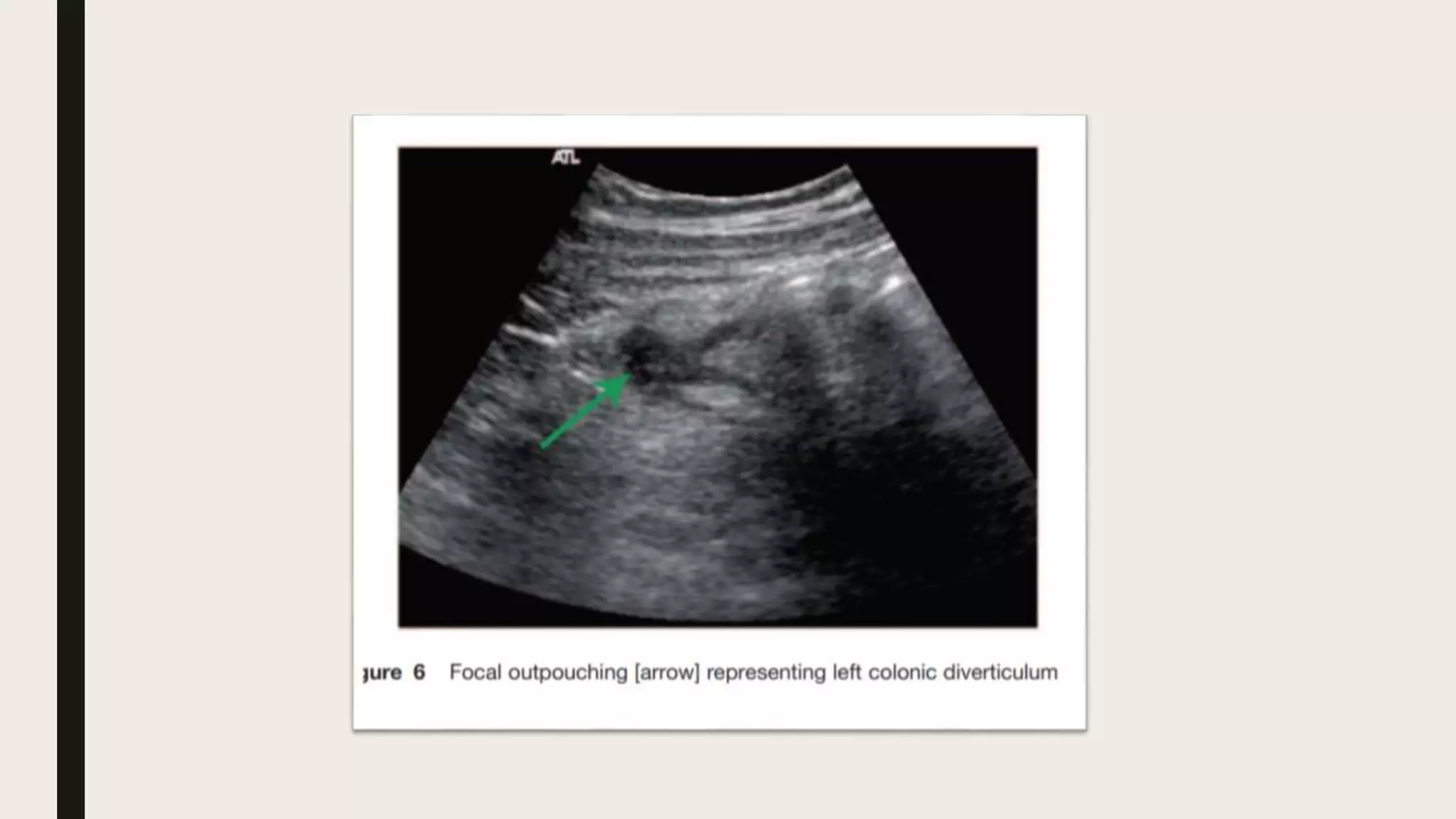 Role of ultrasound in right iliac fossa pain | PPTX