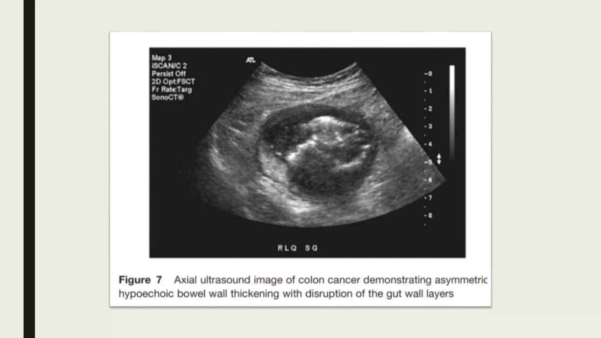 Role of ultrasound in right iliac fossa pain | PPTX