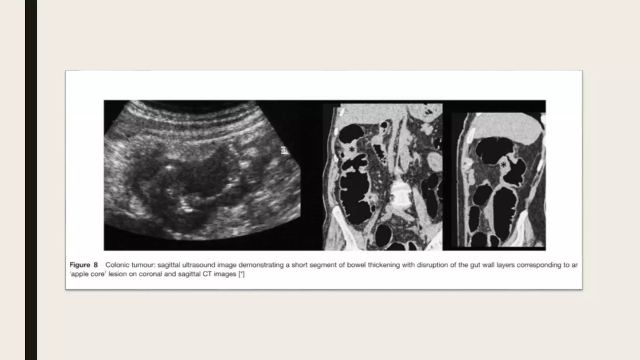 Role of ultrasound in right iliac fossa pain | PPTX