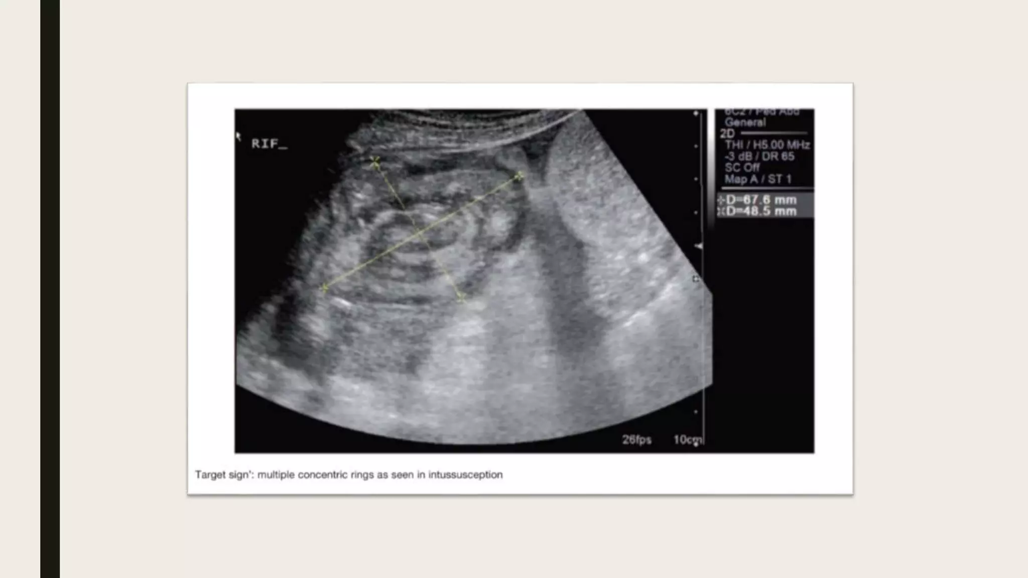 Role of ultrasound in right iliac fossa pain | PPTX