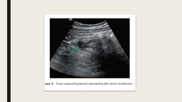 Role of ultrasound in right iliac fossa pain | PPTX