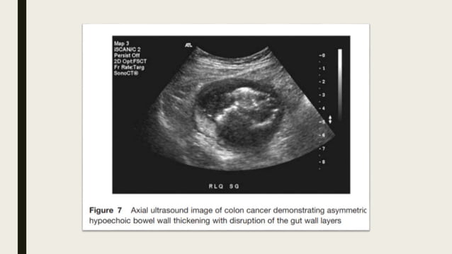 Role of ultrasound in right iliac fossa pain | PPTX