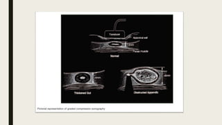 Role of ultrasound in right iliac fossa pain | PPTX