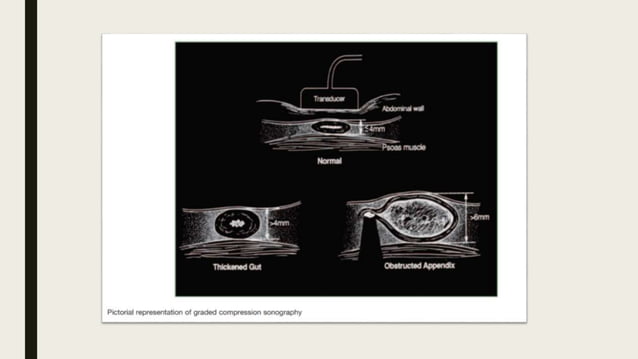 Role of ultrasound in right iliac fossa pain | PPTX