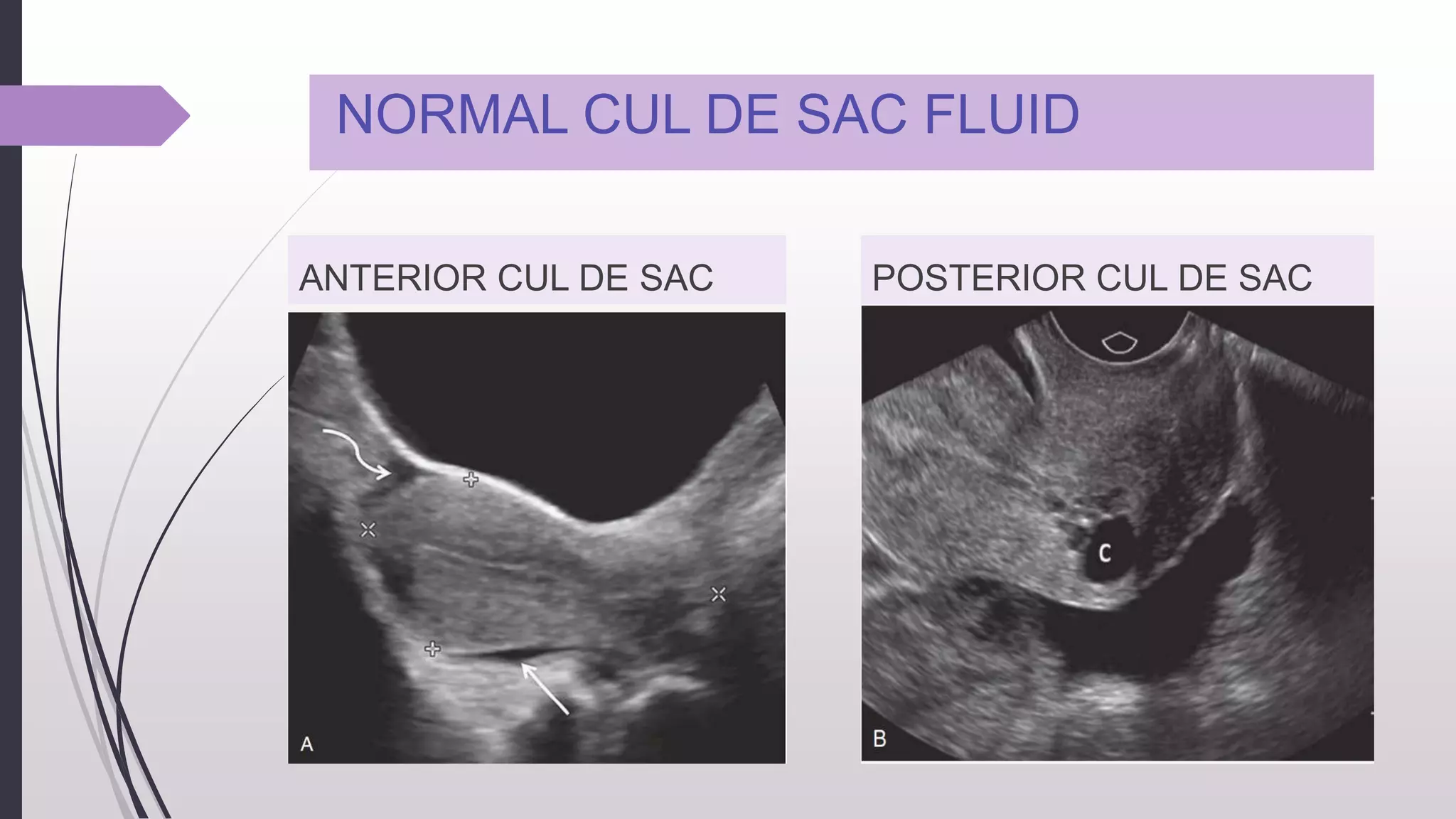Role of ultrasound in the Infertility management | PPTX