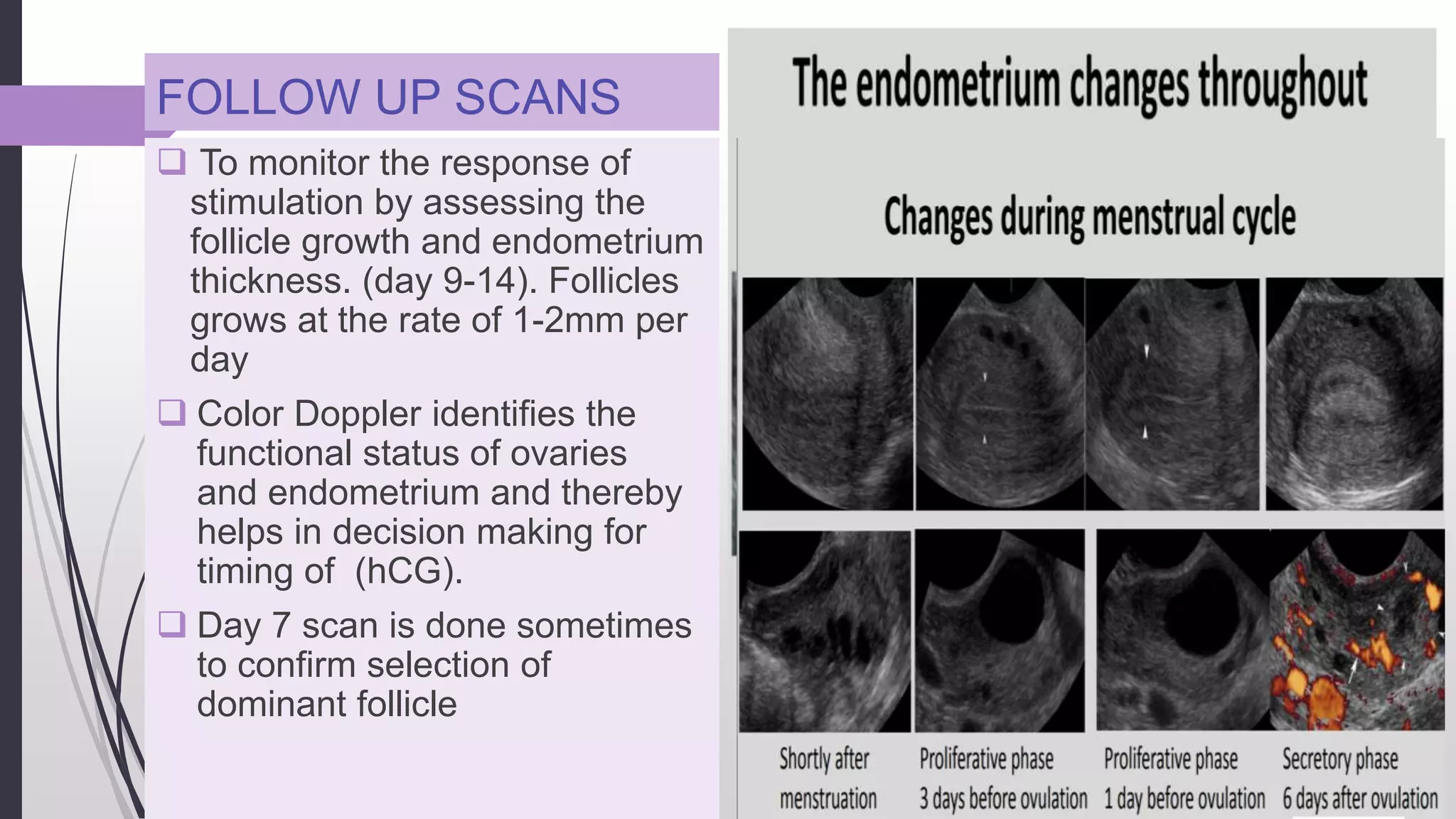 Role of ultrasound in the Infertility management | PPTX