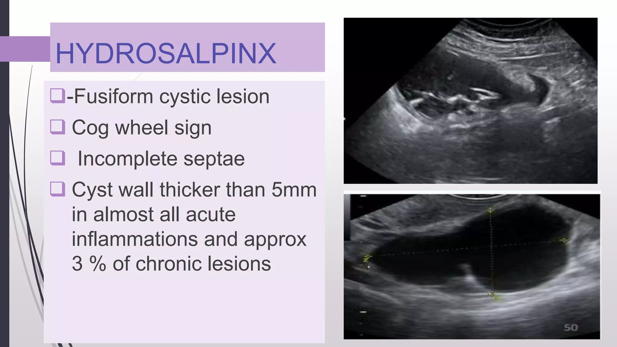 Role of ultrasound in the Infertility management | PPTX