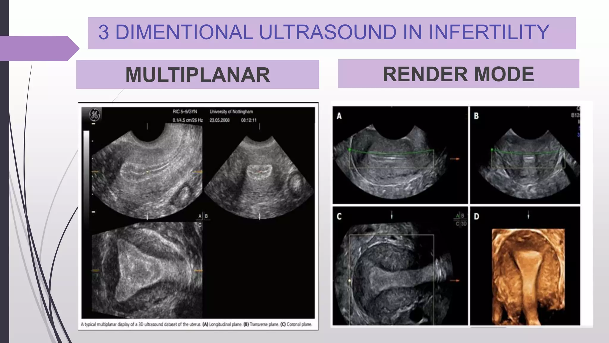 Role Of Ultrasound In The Infertility Management Ppt