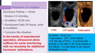 Role of ultrasound in the Infertility management | PPTX
