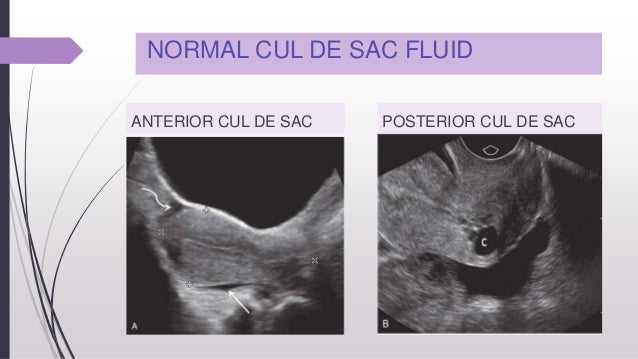 Role Of Ultrasound In The Infertility Management