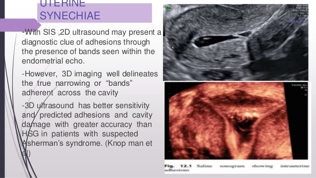 Role Of Ultrasound In The Infertility Management