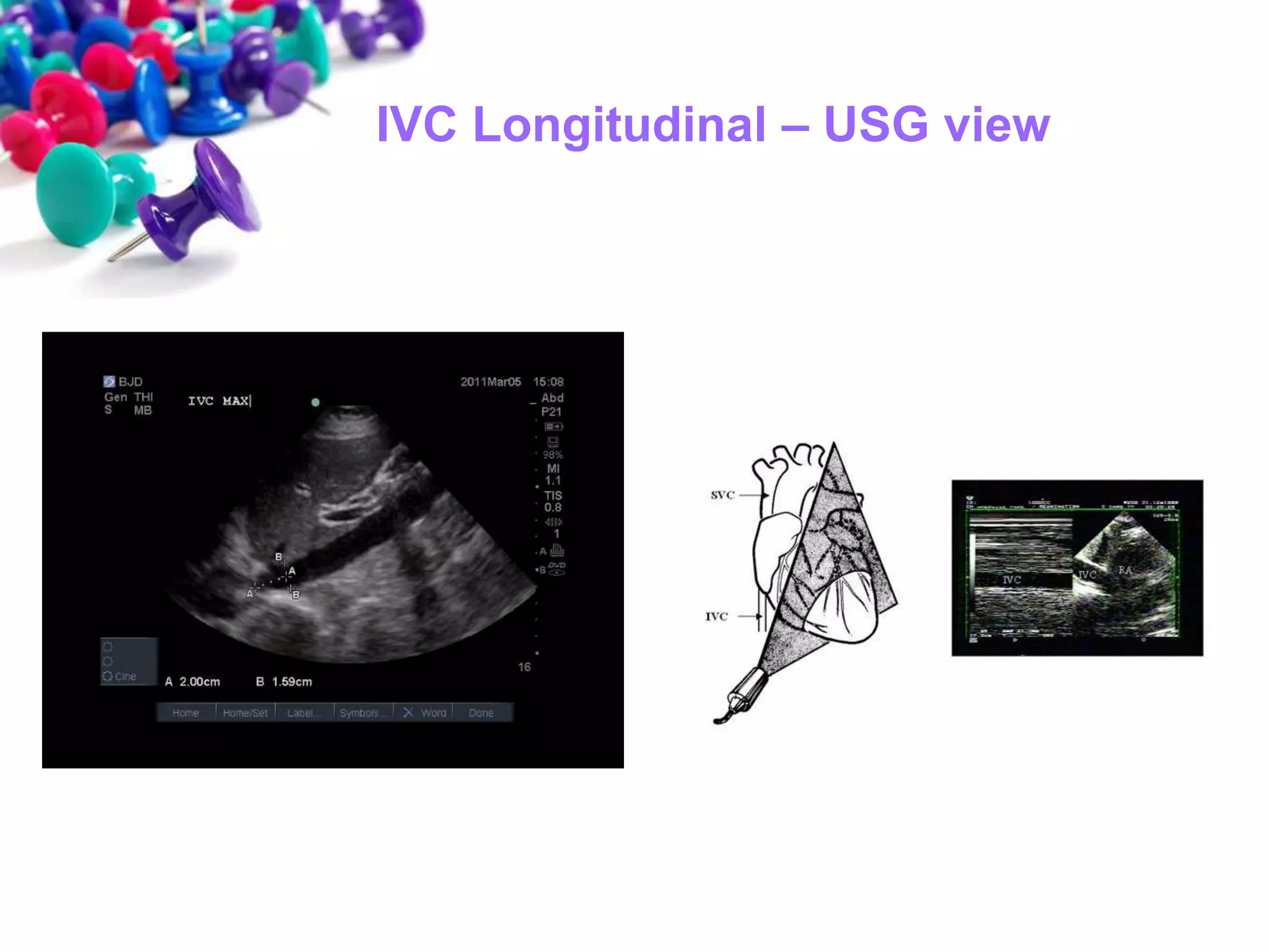Role of ultrasound nurse in critical care | PPTX