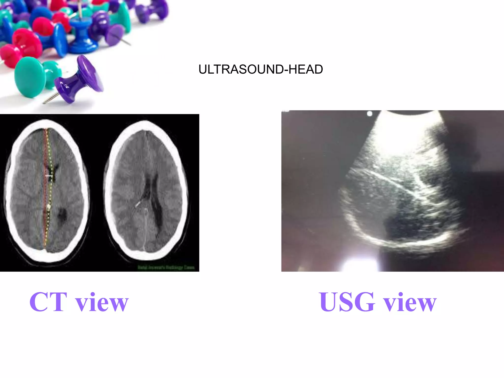 Role of ultrasound nurse in critical care | PPTX
