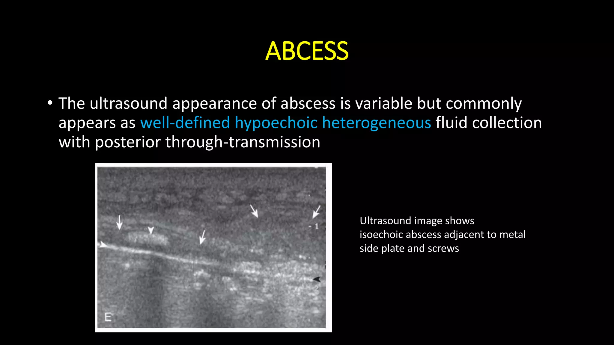 Role of usg in orthopedics | PPTX