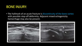 Role of usg in orthopedics | PPTX