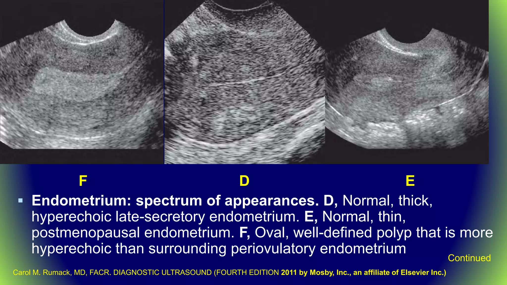 Role of us in evaluation of infertility Dr. Muhammad Bin Zulfiqar | PPTX