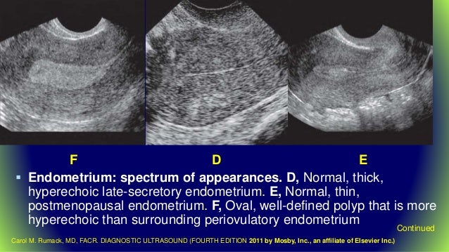 Proliferative Phase Endometrium Ultrasound