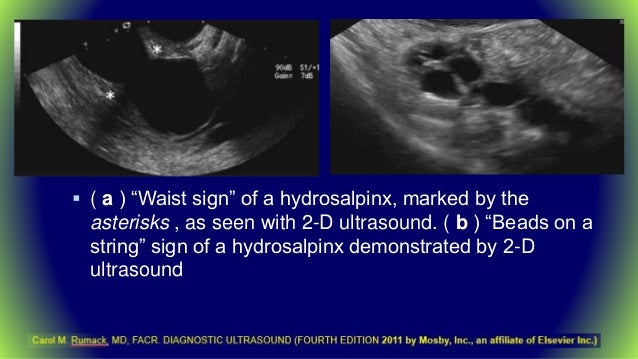 Role of us in evaluation of infertility Dr. Muhammad Bin Zulfiqar