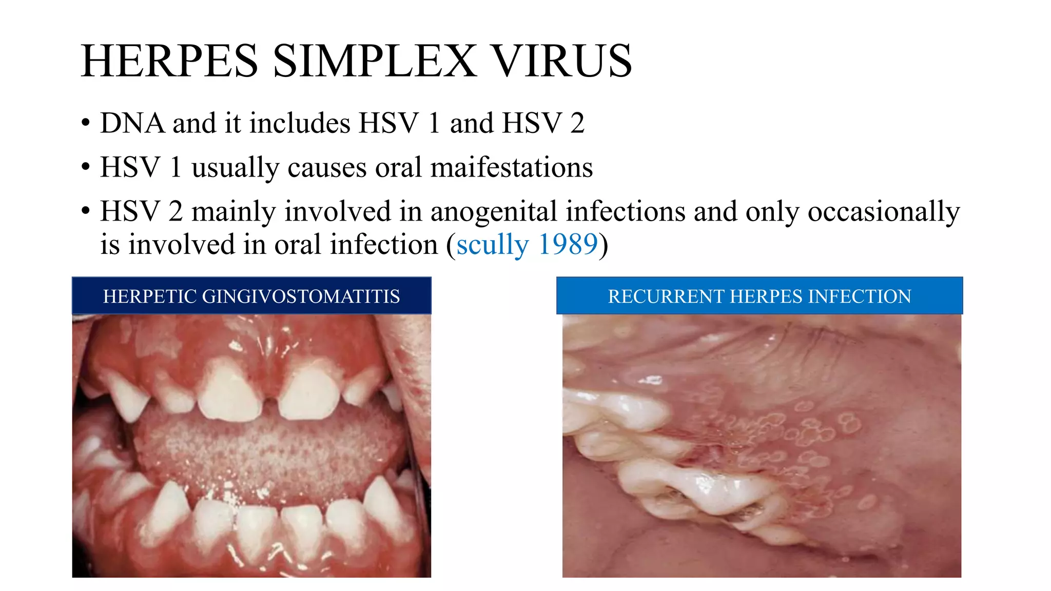 Role of virus in periodontal disease | PPTX