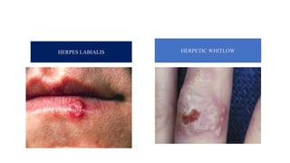 Role of virus in periodontal disease | PPTX