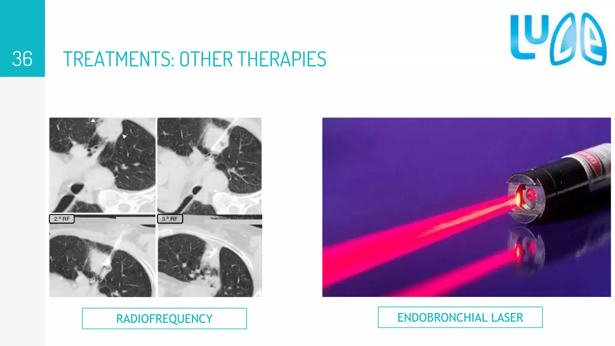 Role radiotherapy lung cancer manegement | PPTX