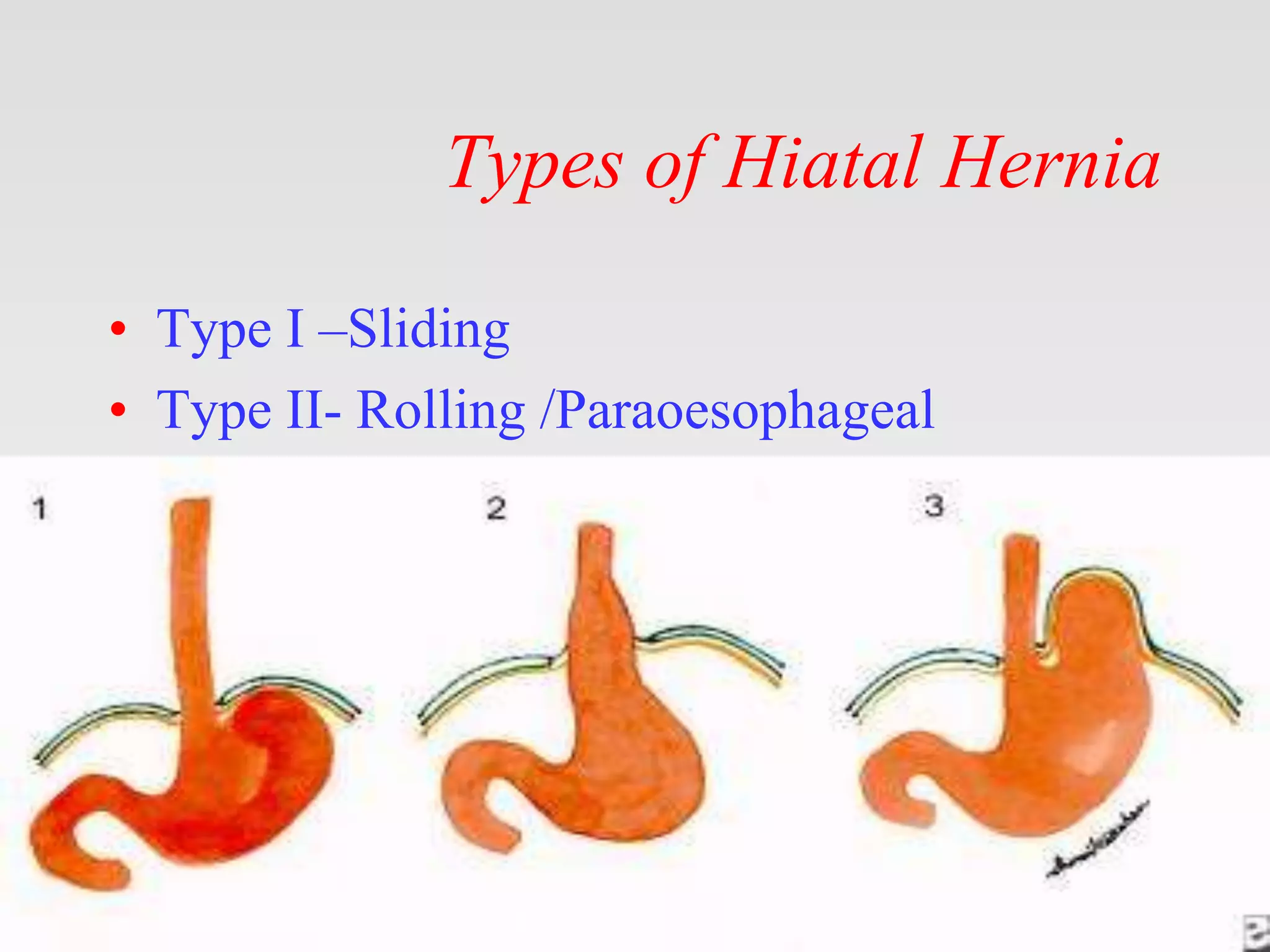 Rolling and sliding hiatal hernia.pptx