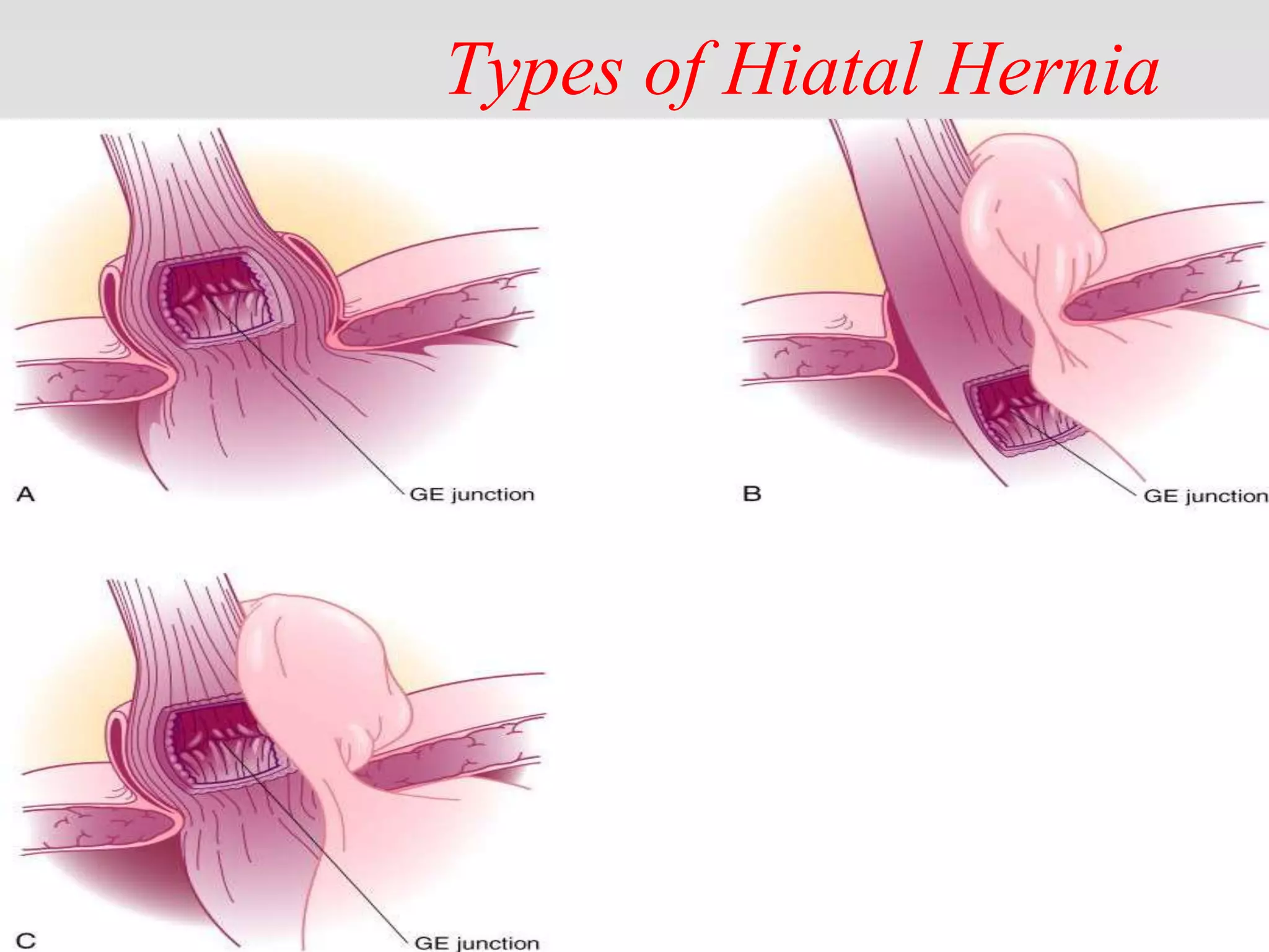 Rolling and sliding hiatal hernia.pptx