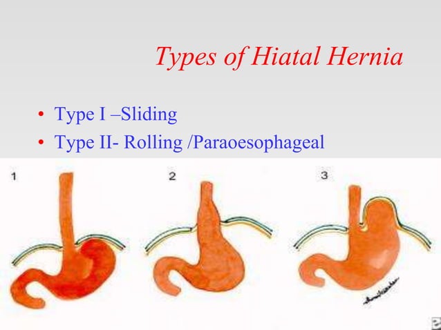 Rolling and sliding hiatal hernia.pptx