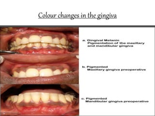 clinical features of gingivitis | PPTX