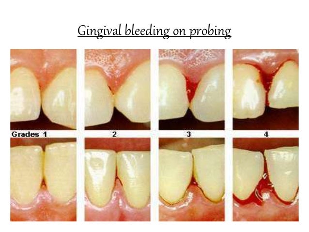 clinical features of gingivitis