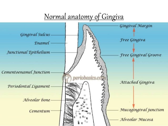 clinical features of gingivitis