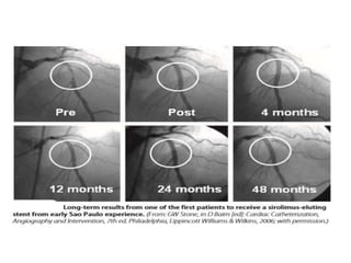 Case Presentation in SOAP format on Ischemic Heart Disease with Acute ...