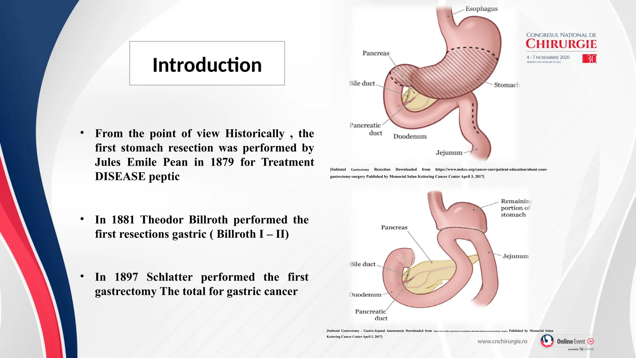THE ROLE OF SUBTOTAL GASTRECTOMY IN THE TREATMENT OF GASTRIC CANCER | PPTX