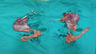 THE ROLE OF SUBTOTAL GASTRECTOMY IN THE TREATMENT OF GASTRIC CANCER | PPT