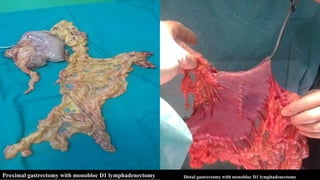 THE ROLE OF SUBTOTAL GASTRECTOMY IN THE TREATMENT OF GASTRIC CANCER | PPTX