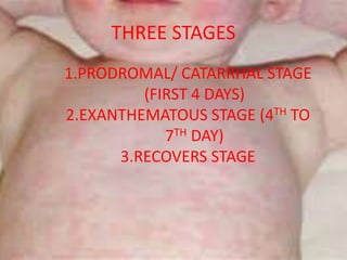 Romantika (measles) | PPTX