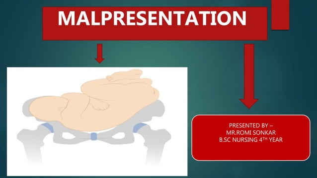 Malpresentation | PPT