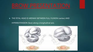 Malpresentation | PPT