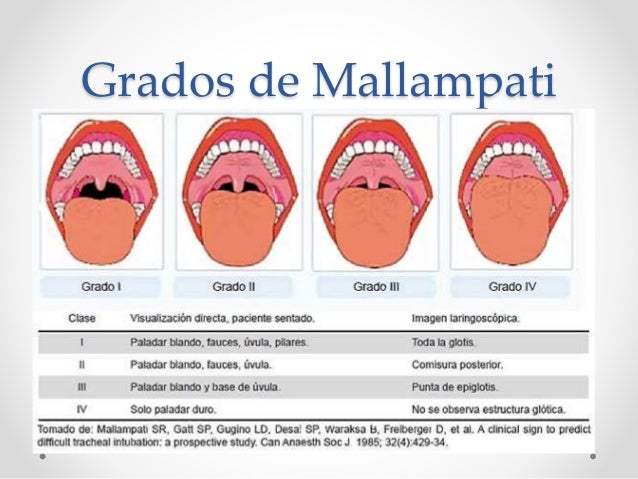 Roncopatía en el adulto