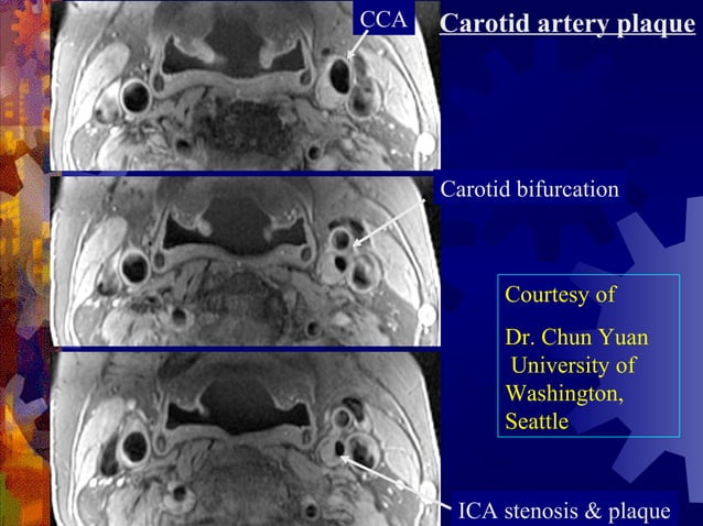 Human carotid mri spio presentation files | PPT