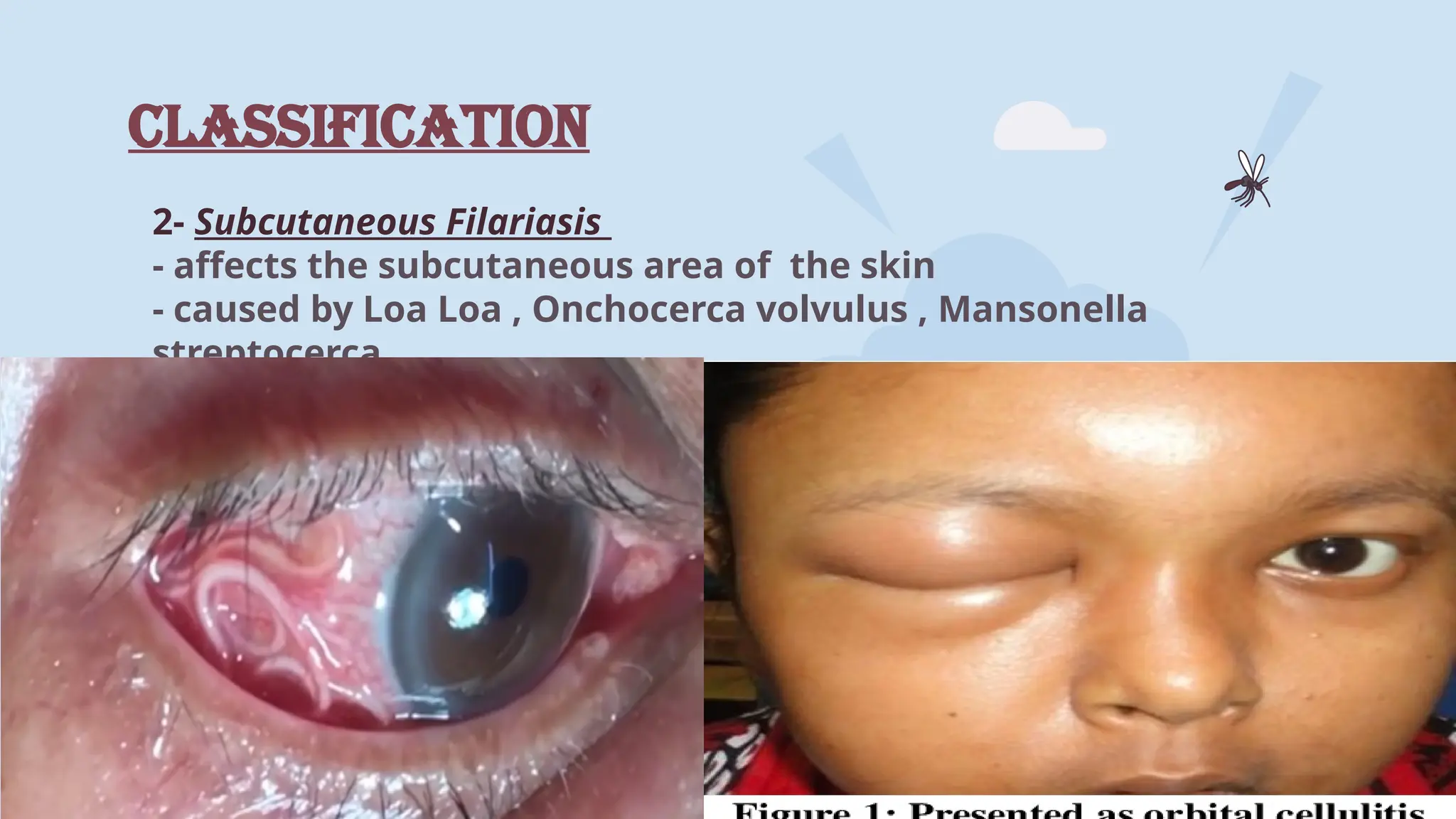 FILARIASIS PPT.................................. | PPTX