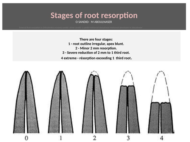 Root-resorption-oussama-sandid-mohamad-aboualnaser-1 | PPT