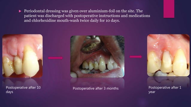 Root Amputation and Perio Esthetic Surgery | PPT