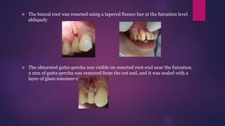 Root Amputation and Perio Esthetic Surgery | PPTX