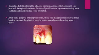 Root Amputation and Perio Esthetic Surgery | PPT