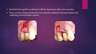 Root Amputation and Perio Esthetic Surgery | PPTX
