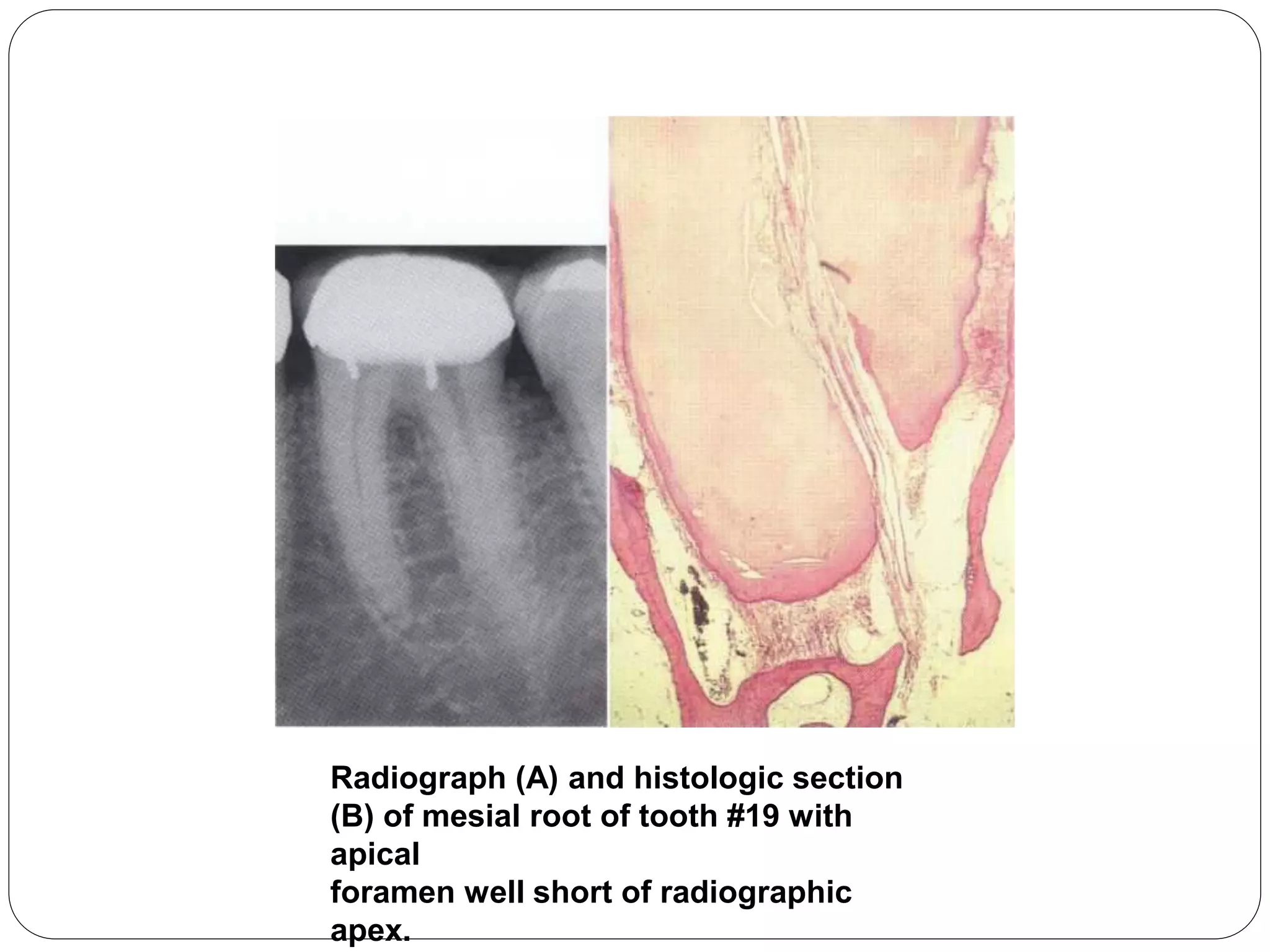 Root apex and working length determination | PPTX
