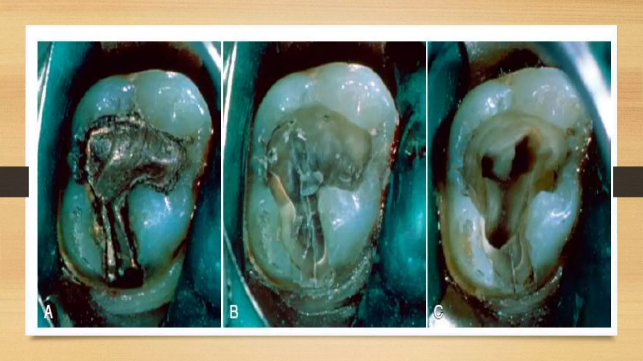 Root canal anatomy | PPTX | Dental Health | Diseases and Conditions