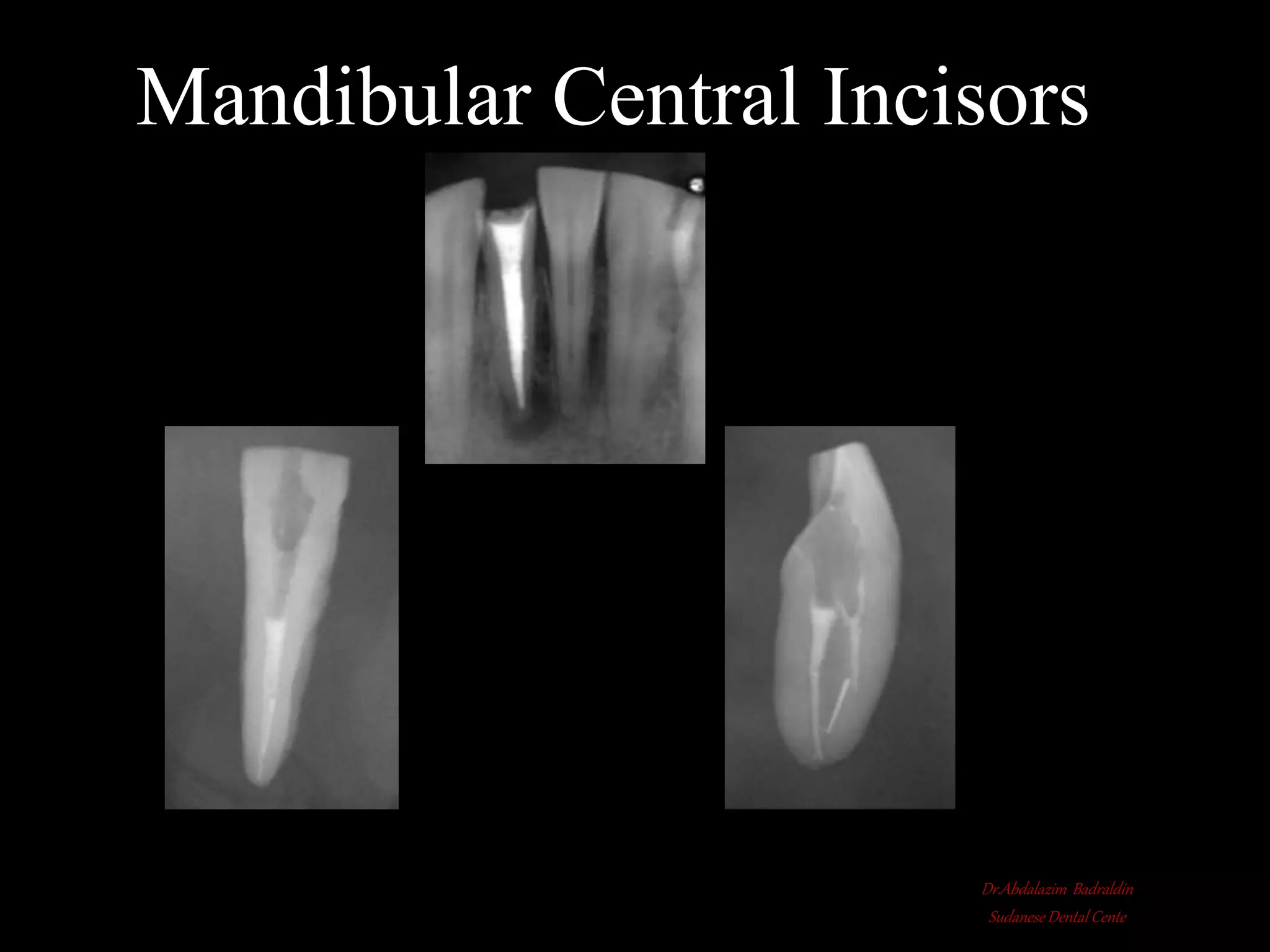Root canal anatomy and configuration project mandibular teeth ...